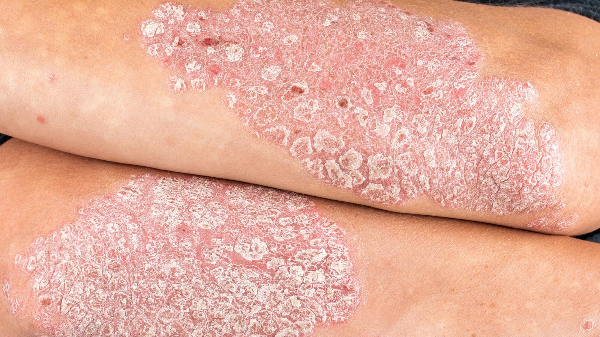 The Truth About Psoriasis: Causes, Symptoms, and Available Treatments